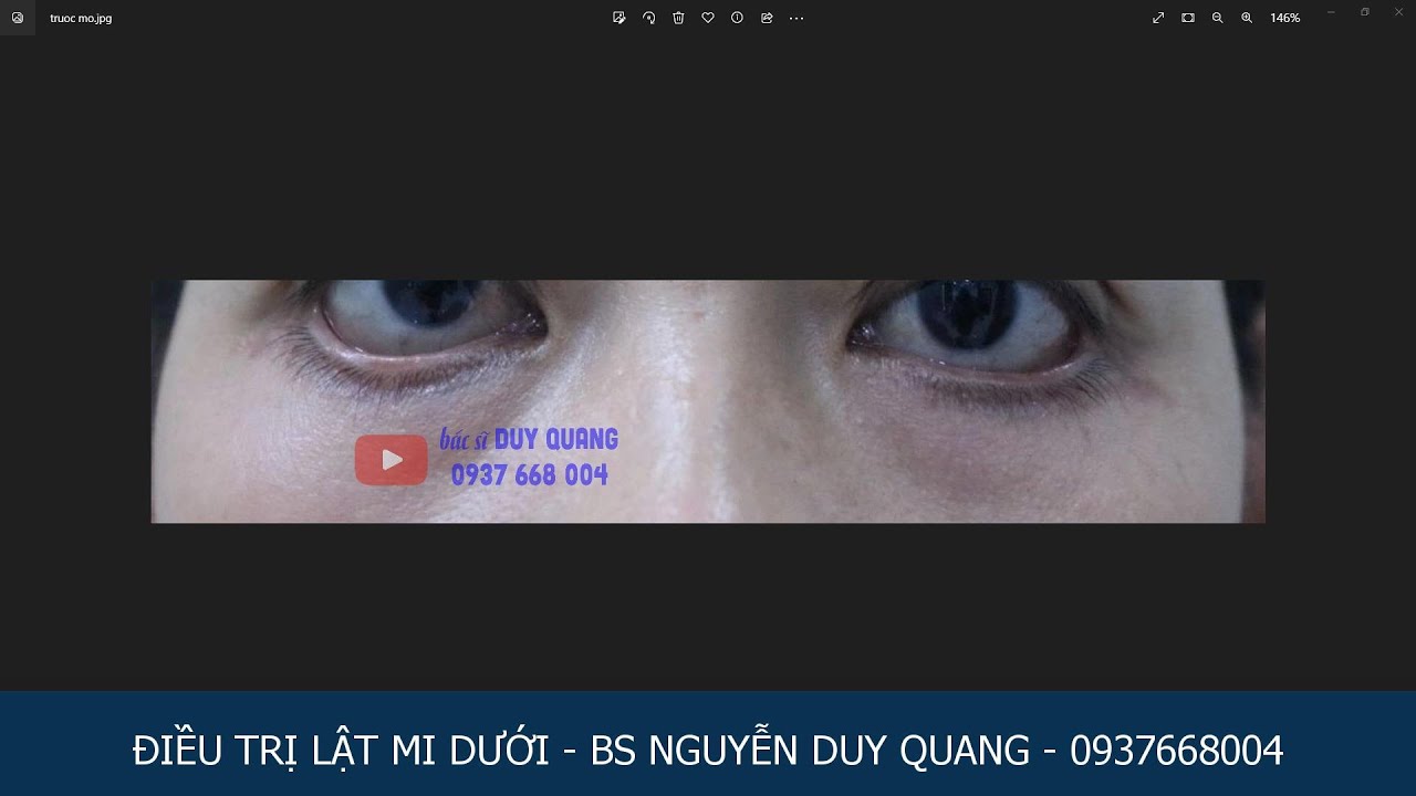 Điều trị Lật mí, hở mí bằng tạo hình góc mắt ngoài I BS Nguyễn Duy Quang I Thẩm mỹ - Làm đẹp ...