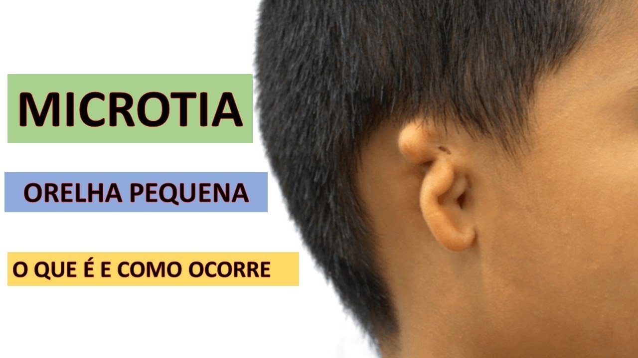 MICROTIA | ORELHA PEQUENA. - YouTube
