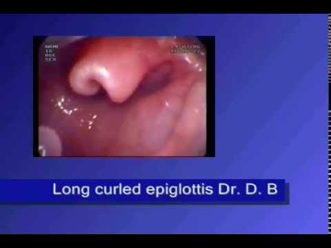 Laryngomalacia Various types 3min 22apr10 DB - YouTube