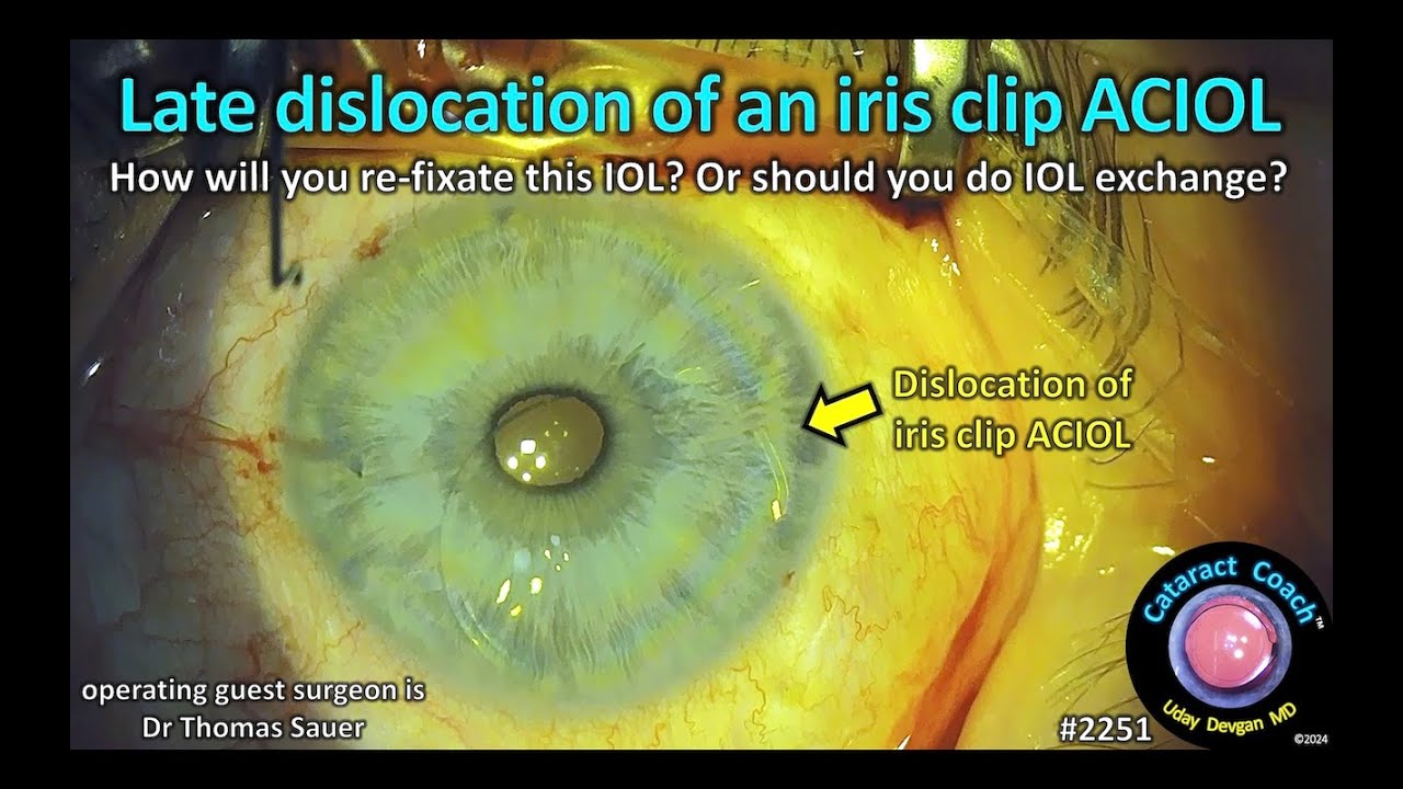 CataractCoach™ 2251: late dislocation of an iris clip ACIOL - YouTube