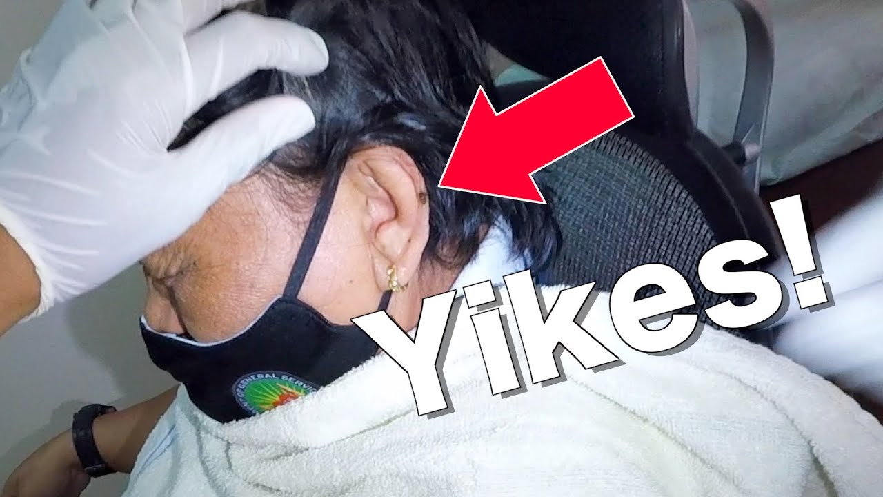 Stuck Insect Crawls Out From Woman's Ear - YouTube