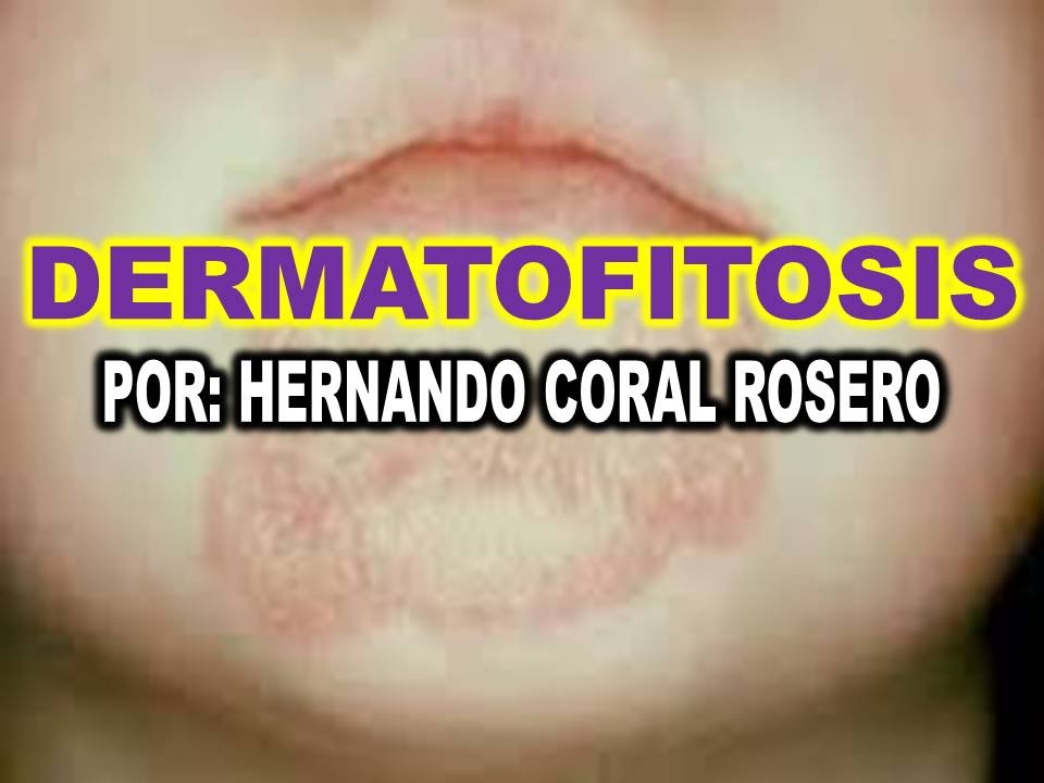 DERMATOFITOSIS - AFECCIONES DE LA PIEL, UÑAS Y PELOS POR HONGOS Y ...