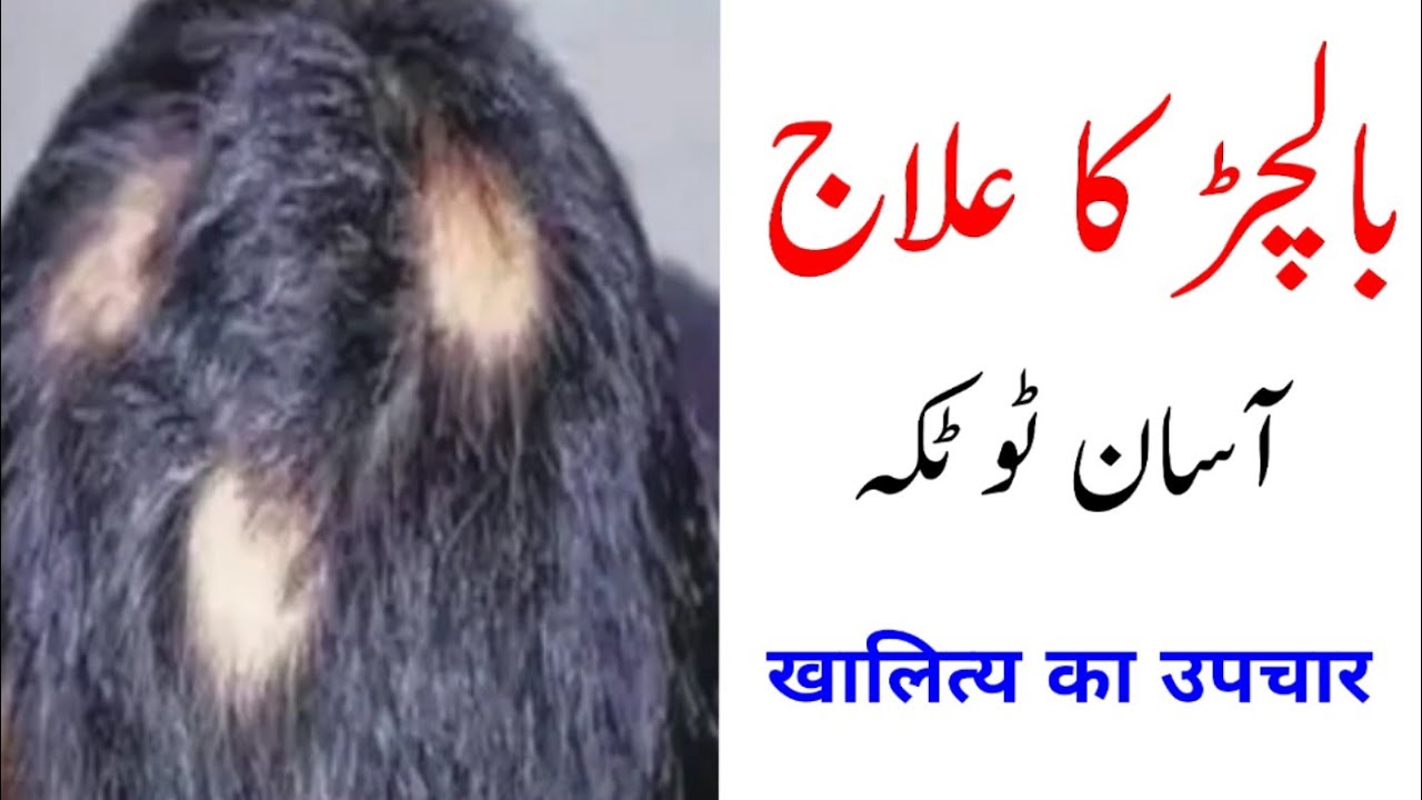 Balchar ka ilaj | How to treat alopecia | Balchar home remedy ...