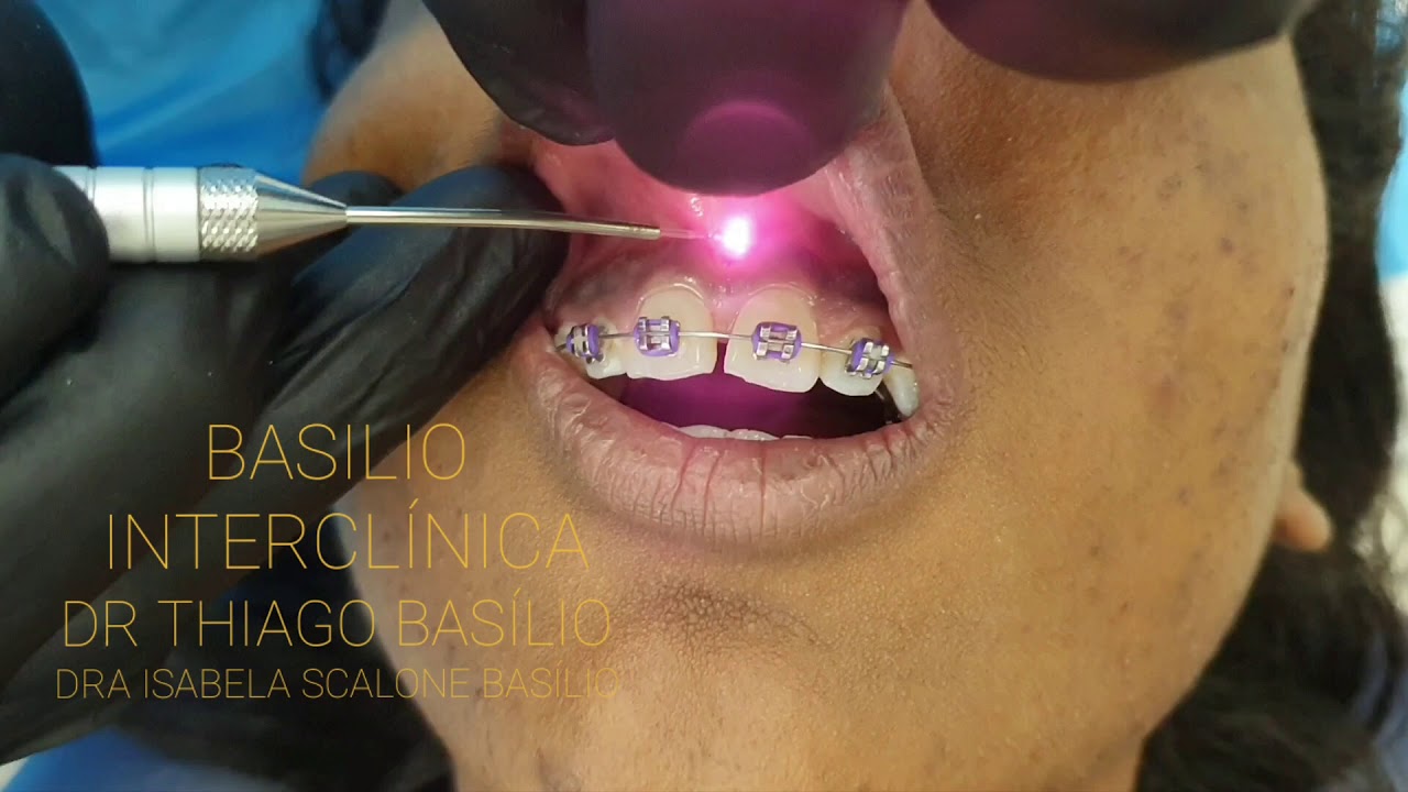 FRENECTOMIA UTILIZANDO LASER CIRÚRGICO THERA LASE DMC - YouTube