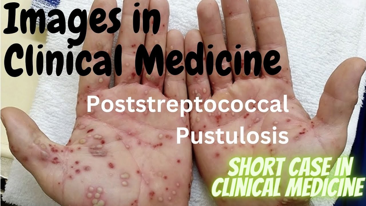 Rare Skin Condition: Poststreptococcal Pustulosis - A Case Study and ...