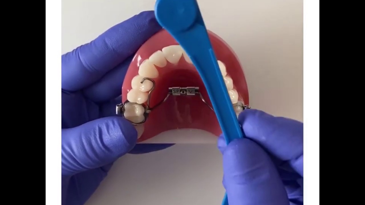 Expander FAQs - STO Orthodontists - YouTube