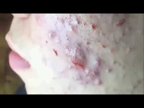 Amazing Blackhead Extraction - YouTube