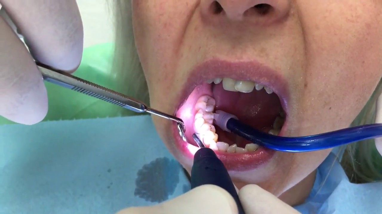 DioDent - чистка зубов с помощью Air-flow - YouTube