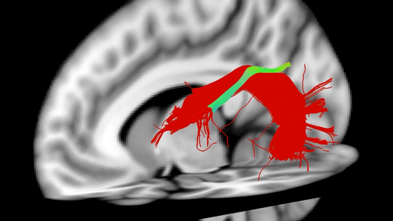 Animated 3D model of arcuate fasciculus segments - YouTube