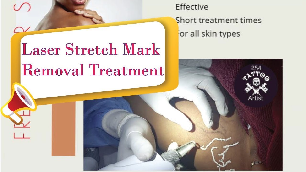 Laser Stretch Mark Removal Treatment in Nairobi Kenya - YouTube