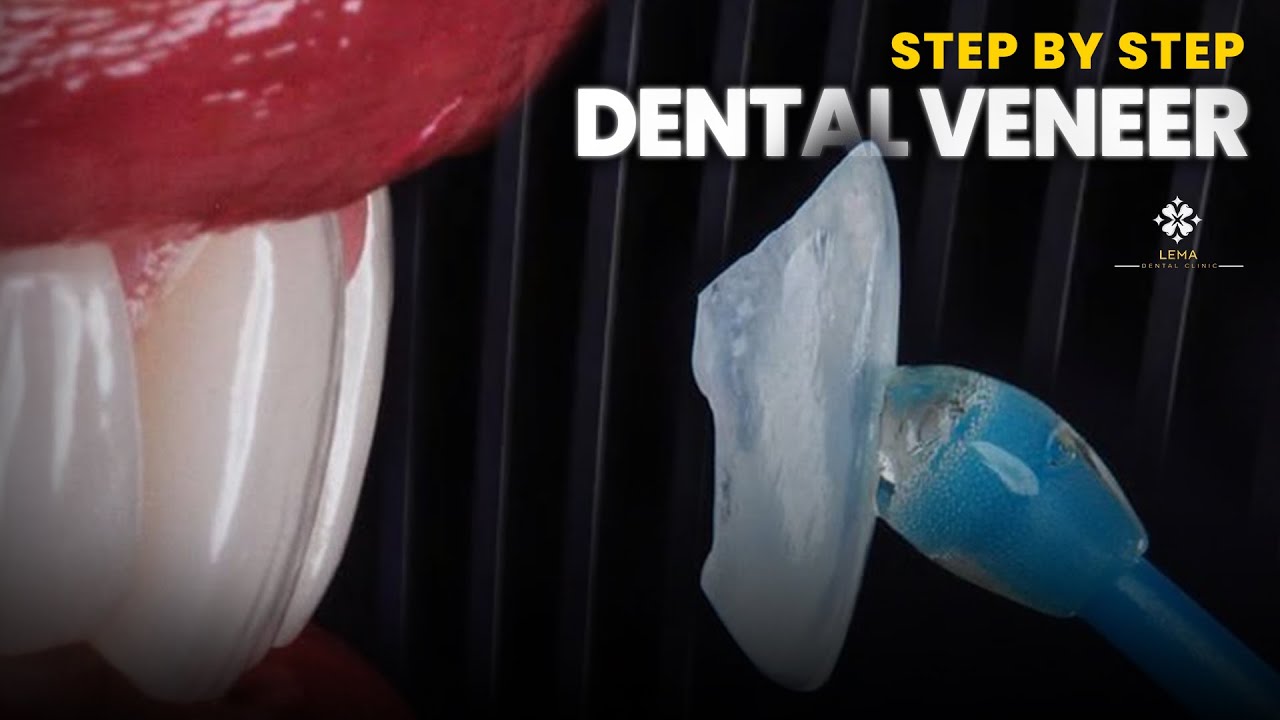 🤍 Step-by-Step Dental Veneers Procedure in Istanbul, Turkey - Lema ...