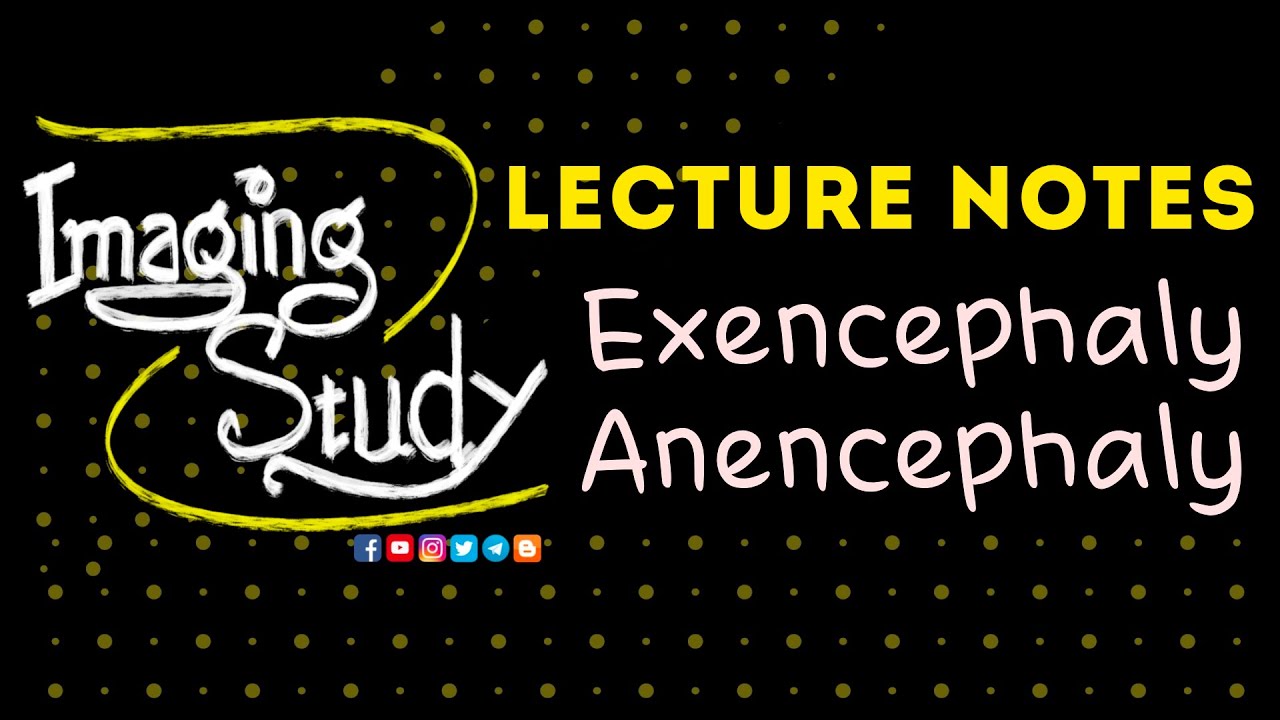 Exencephaly - Anencephaly: Imaging Study Lecture - YouTube