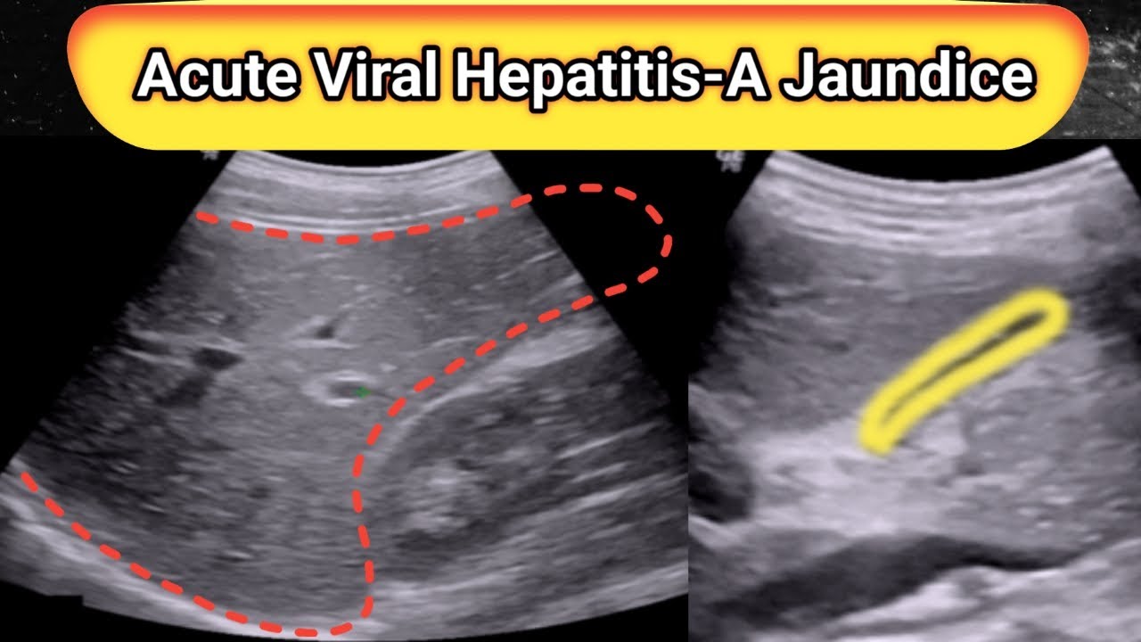 Ultrasound Liver - Acute Viral Hepatitis A | Diagnosis - YouTube