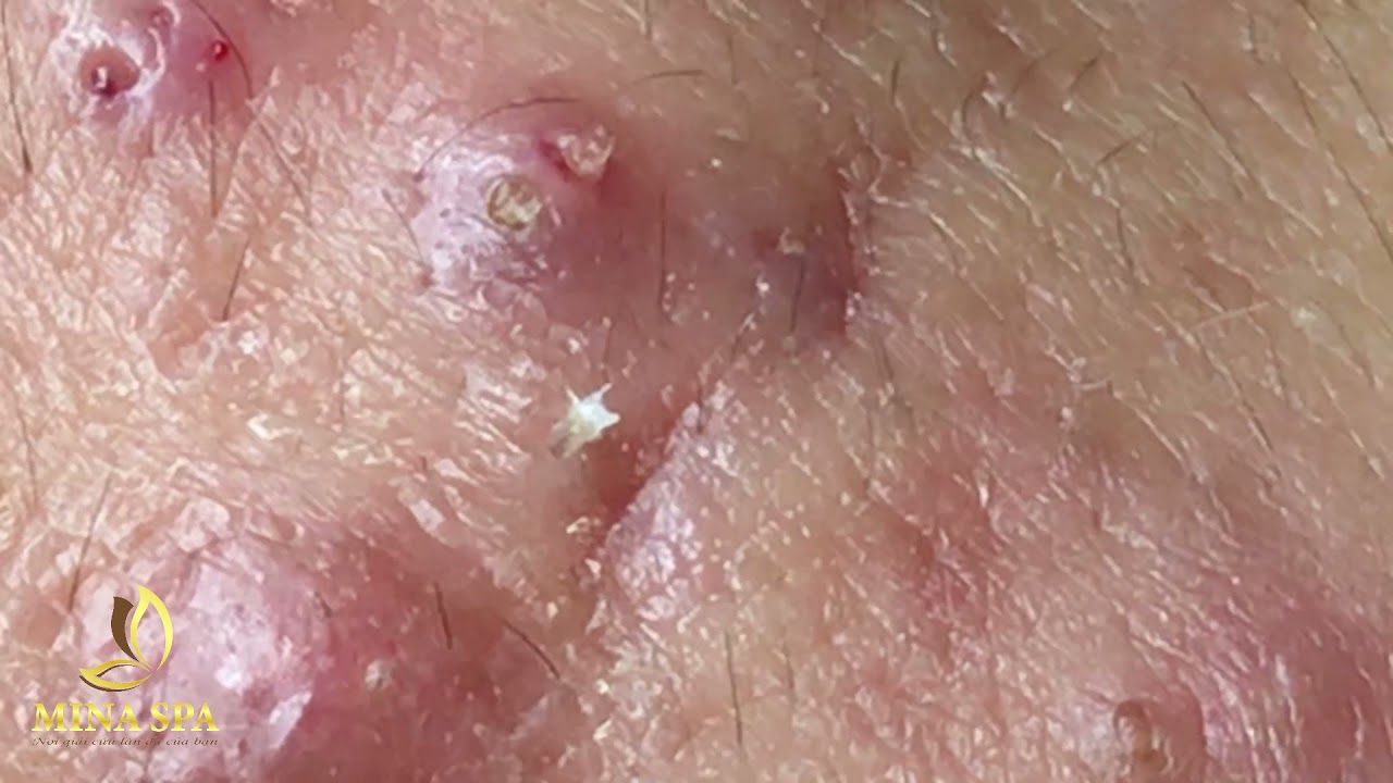 Satisfying ACNE, REMOVE HIDDEN ACNE. Skin Care by Mina Spa | Mina Spa ...