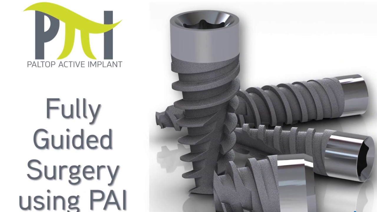 Paltop Fully Guided Surgery using a PAI implant - YouTube