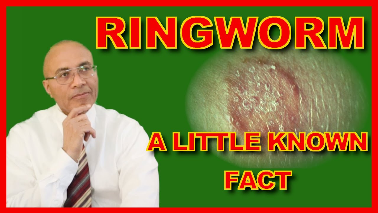 Ringworm (Can It Cause Skin Cancer?) - YouTube