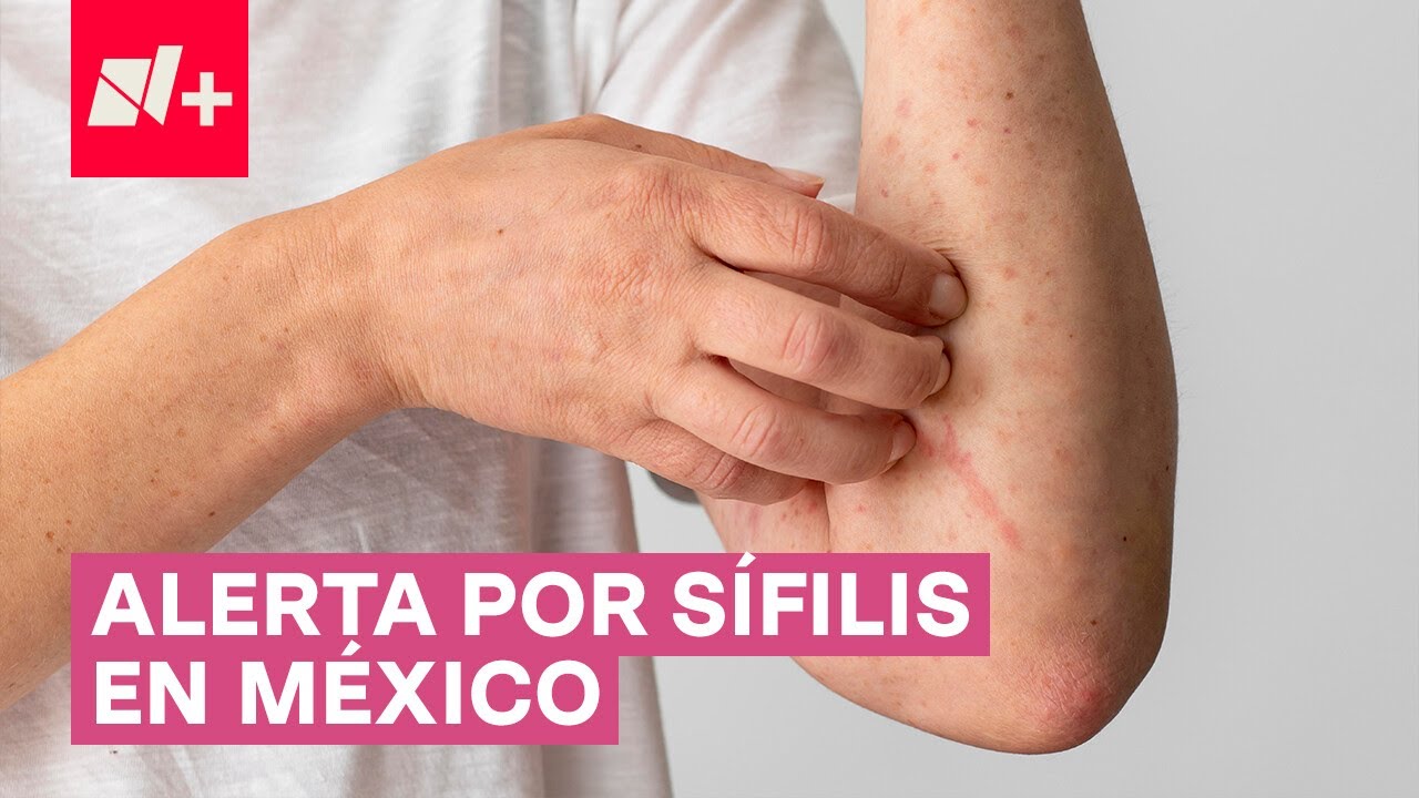 Sífilis; ¿Cómo detectar la enfermedad que alerta a México? - N+ - YouTube