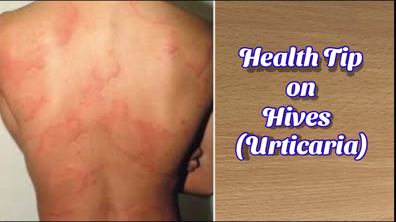 Hives | Urticaria - Causes, Symptoms, Treatment | Health Tips - YouTube
