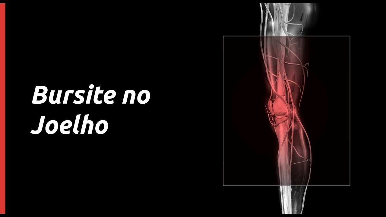 Saiba tudo sobre: Bursite no Joelho - YouTube