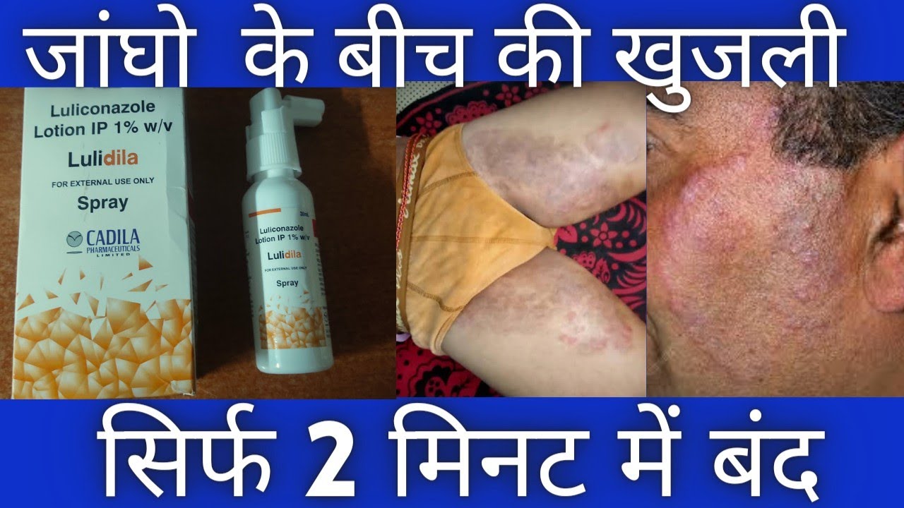 luliconazole Lotion IP 1% w/v Lotion lulidila // lulidila cream uses in ...