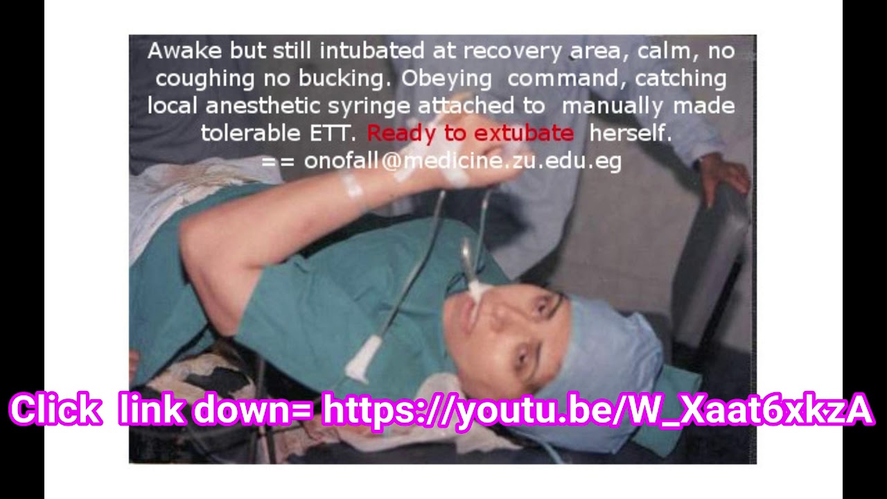 Awake extubation.Tolerable endotracheal tube. - YouTube