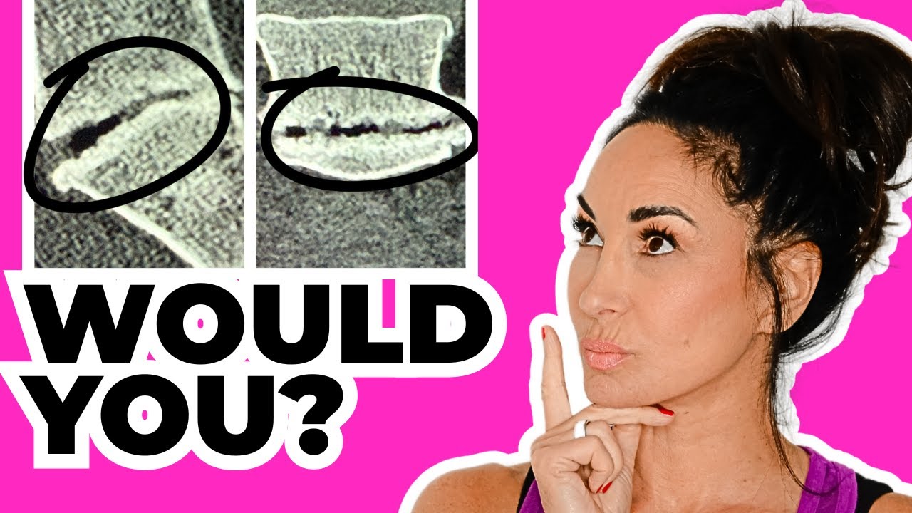 Why I’m Having a Disc Replacement Surgery - YouTube