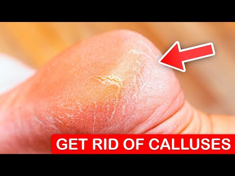 3 Fast Ways to Get Rid of Calluses - YouTube