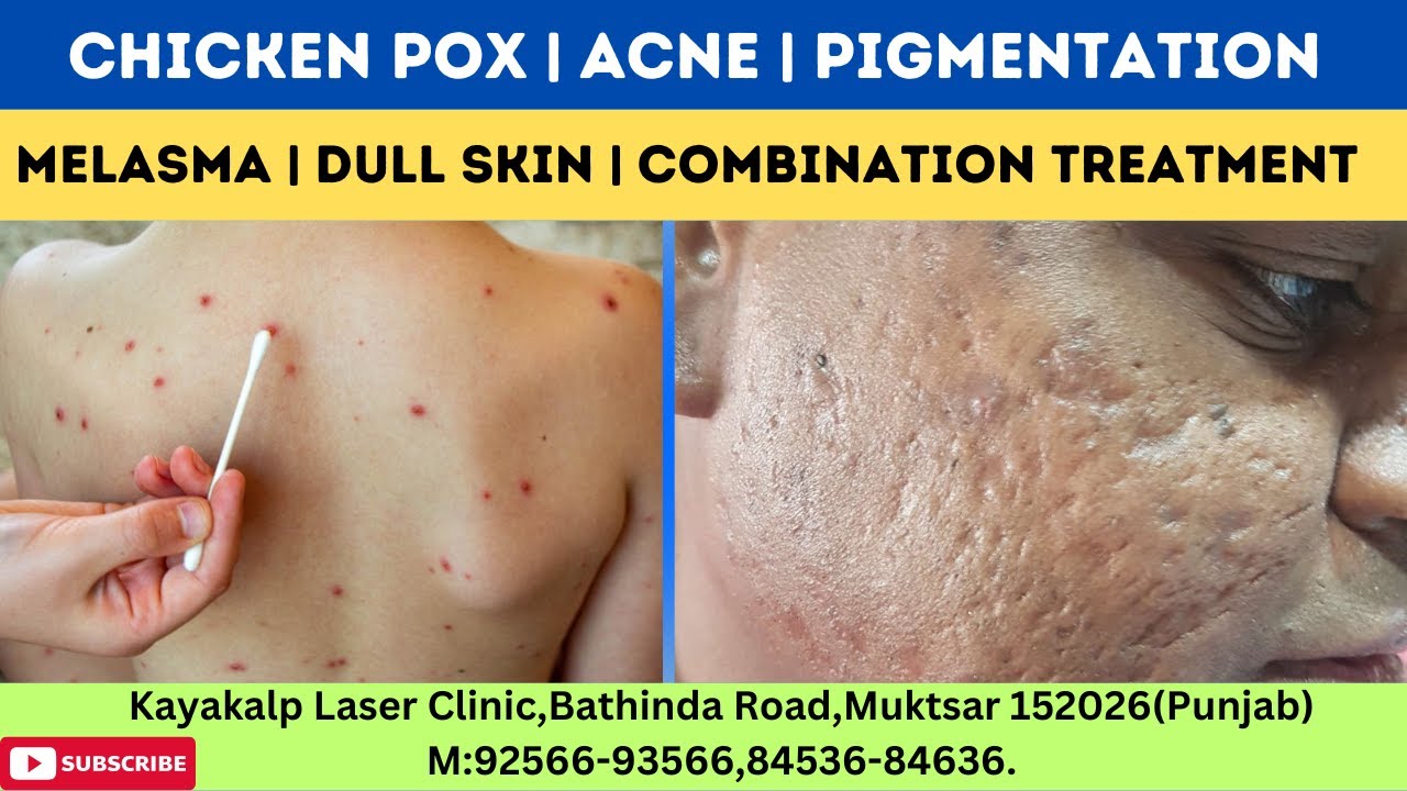 Chicken Pox | Acne | Pigmentation | Melasma | Dull Skin | Combination ...