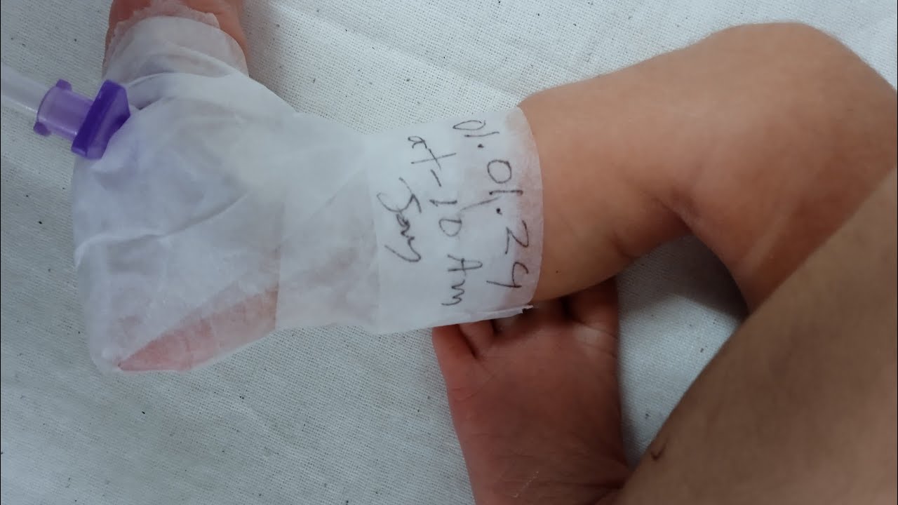 iv cannula technic 26g/iv catheter inserting / iv cannula / cannula ...