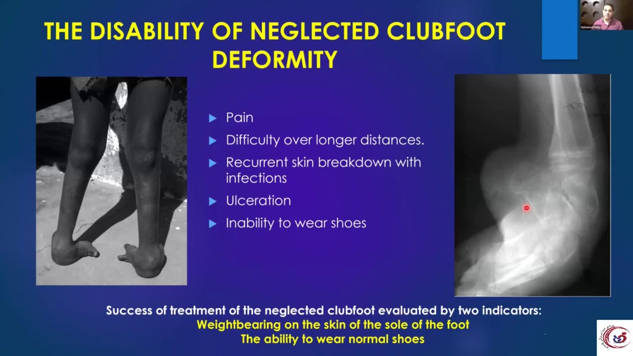 Relapsed neglected clubfoot Dr Mohamed Fathey nasrcity covid19 time ...