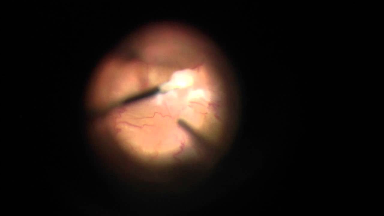 Vitrectomy for Posterior PVR Macular Pucker - YouTube