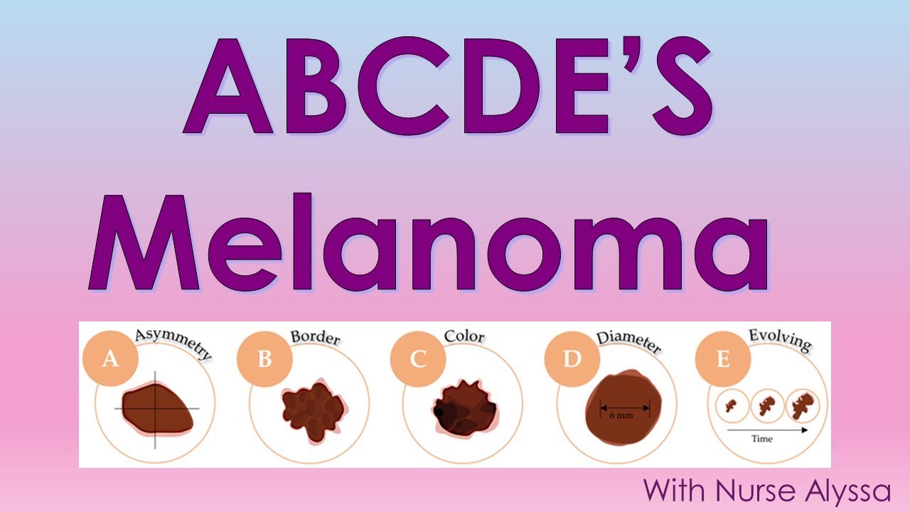 ABCDE's OF Melanoma - YouTube