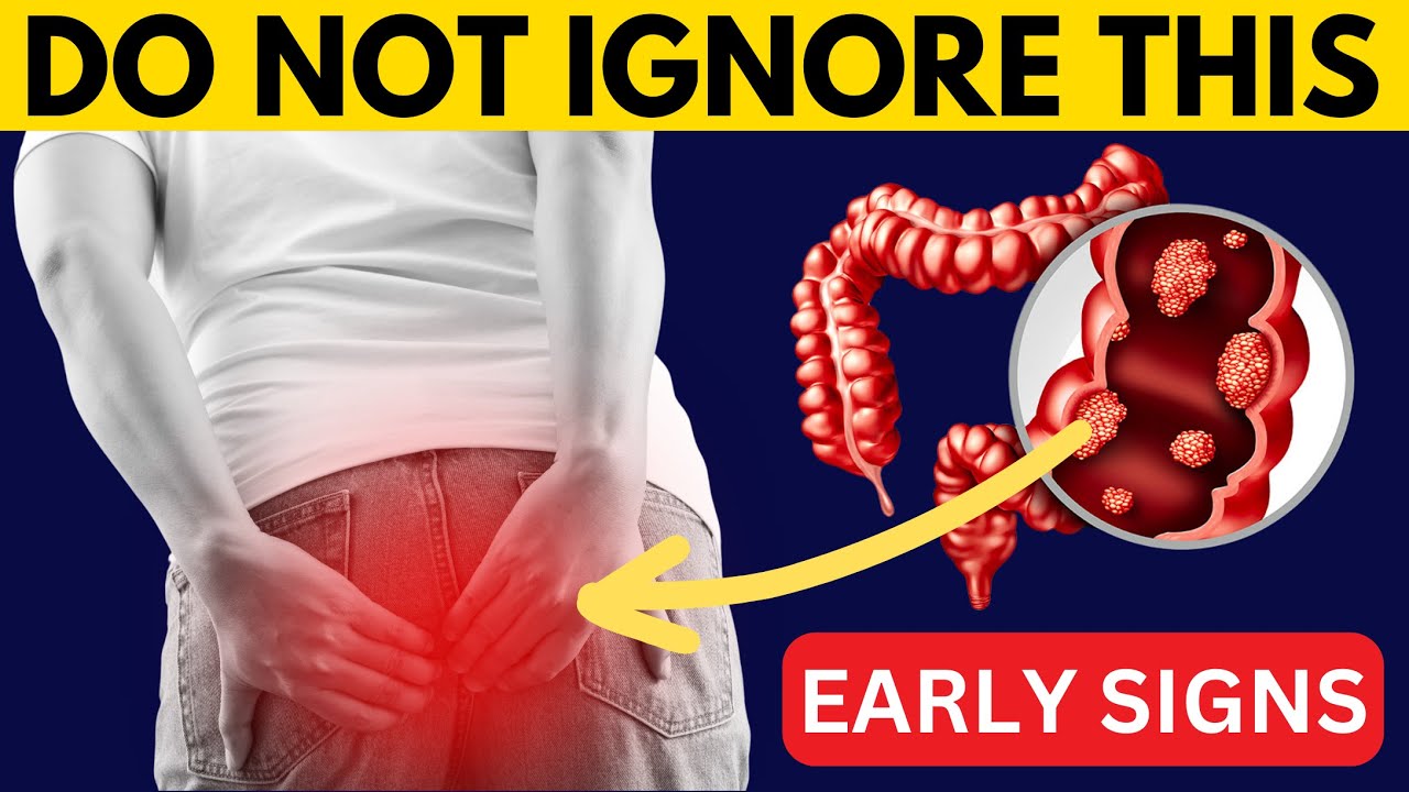 Early Signs of Colon Cancer You Should NOT Ignore. - YouTube