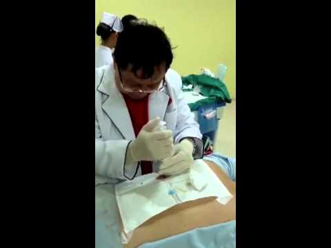 Trans Thorasic Needle Aspiration - YouTube