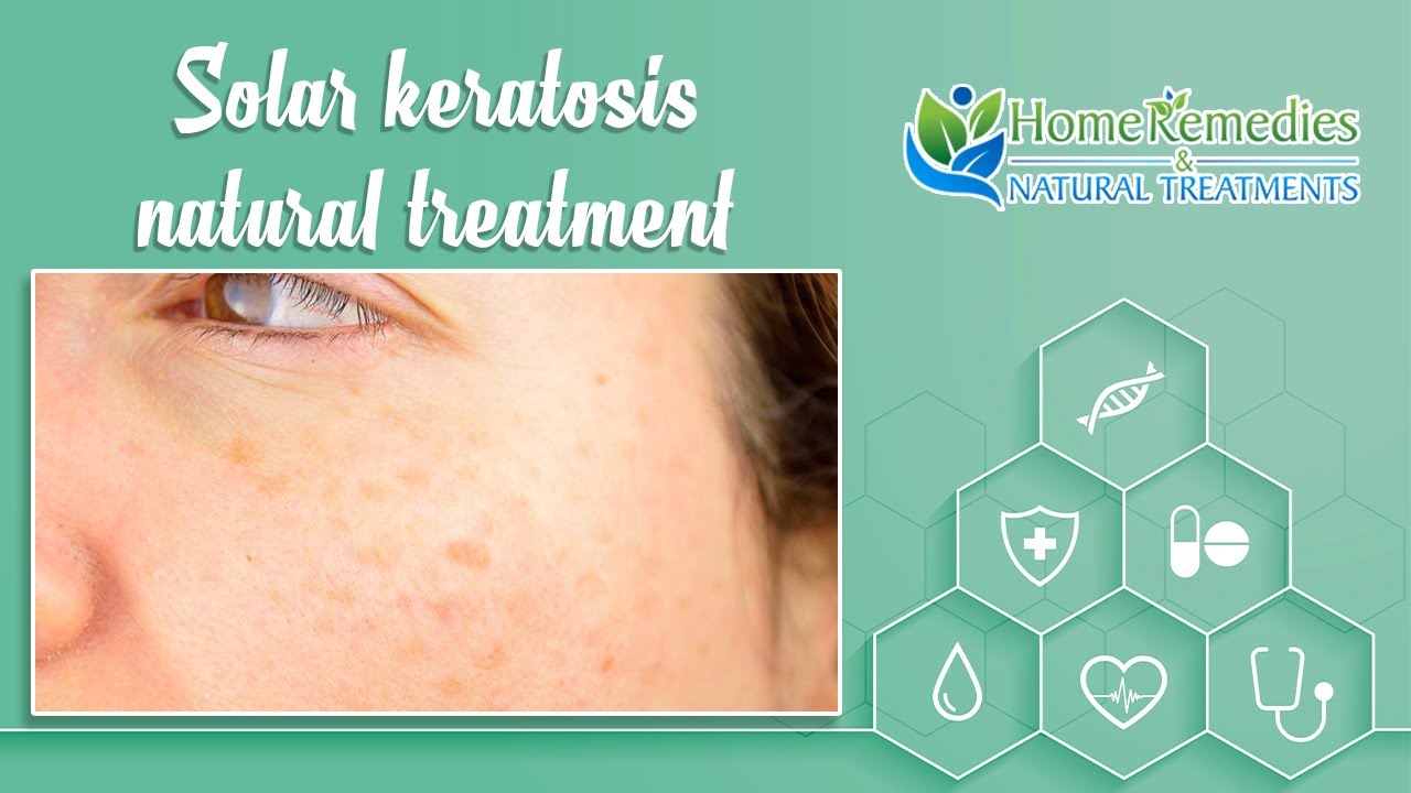 Solar Keratosis Home Treatment How To Treat Solar Keratosis Solar