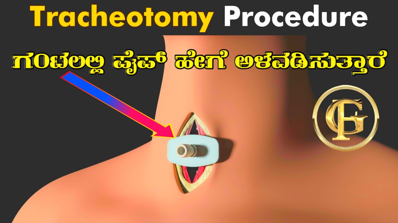 Tracheotomy | Tracheotomy 3D Animation || Trachea | Tracheostomy gfacts ...