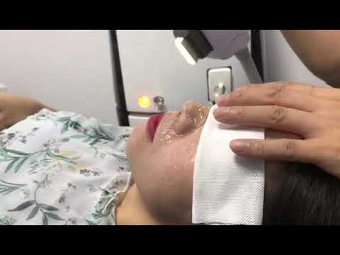 DPL Treatment in the demo #DPL #IPL #LaserBeauty #HuafeiMedical - YouTube