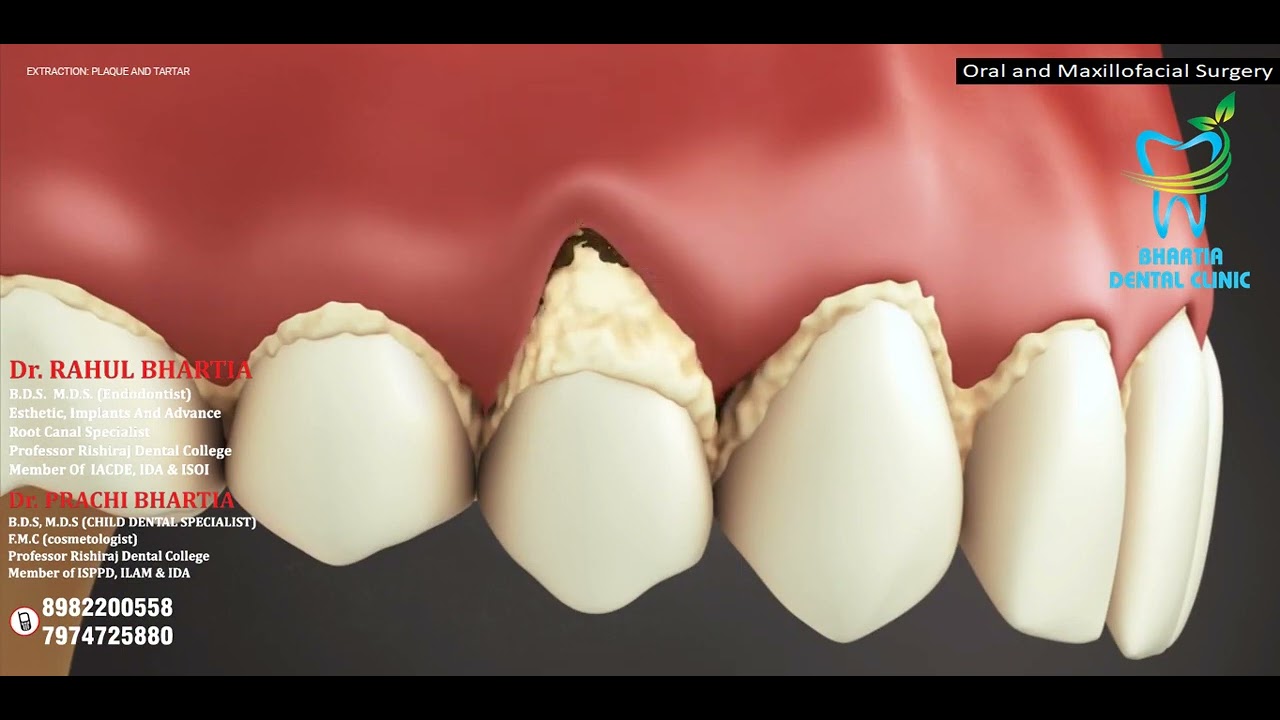 Understanding Tooth Extractions: Causes and Replacement Options - YouTube