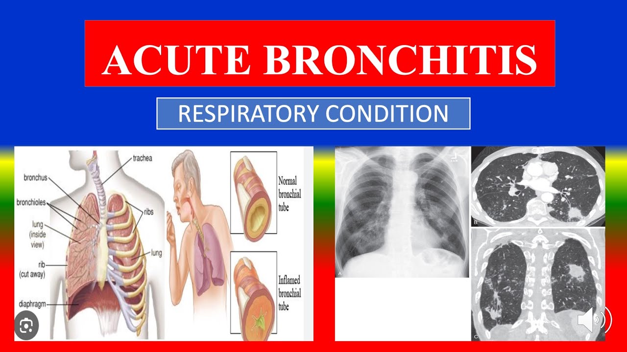 ACUTE BRONCHITIS - Definition, types, cusses, pathophysiology, signs ...