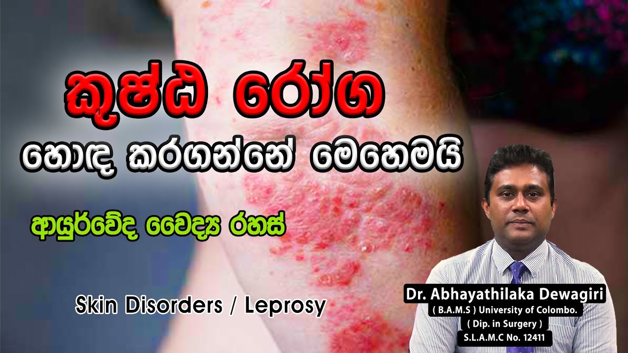 කුෂ්ඨ රෝග ගැන ඔබ දන්නවාද? | Kushta Roga / Skin Disorders / Leprosy | Dr ...