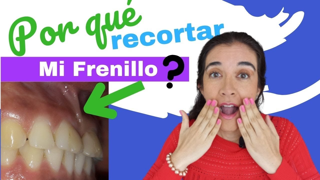 ¿Por qué debo recortarme el FRENILLO LABIAL? Frenillo lingual - YouTube
