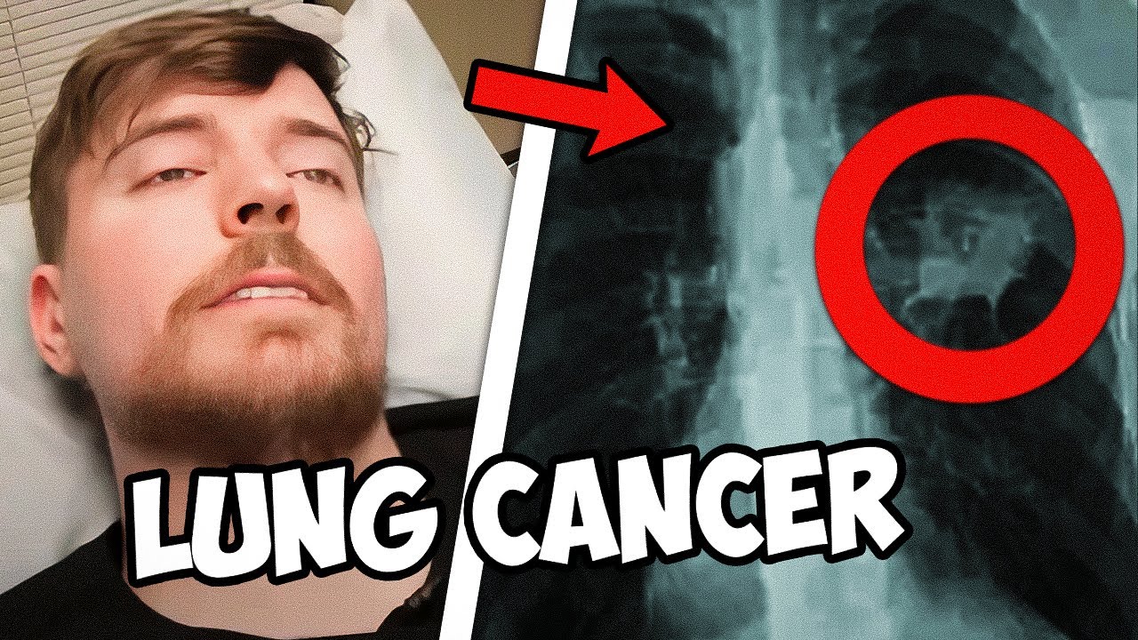 MrBeast Diagnosed with Lung Cancer. How much time does he have left ...