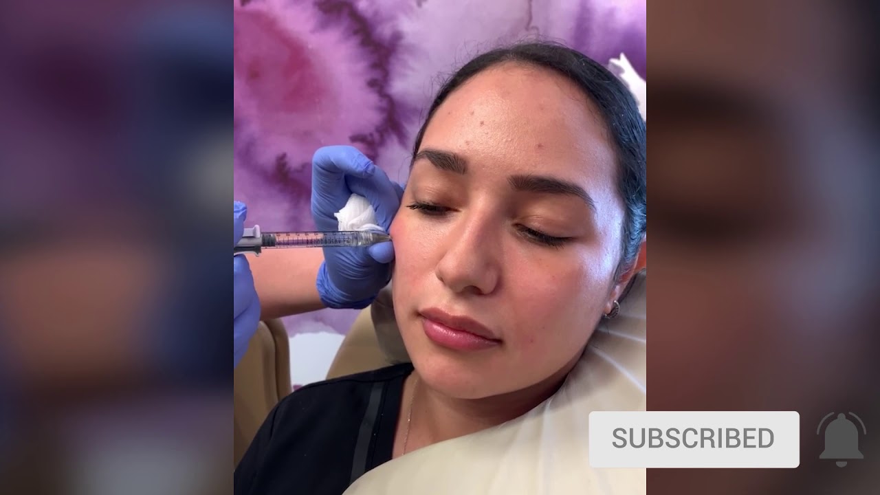 Stephanie’s Cheek Pop with Filler Injections by Dr. Michelle Ellern ...