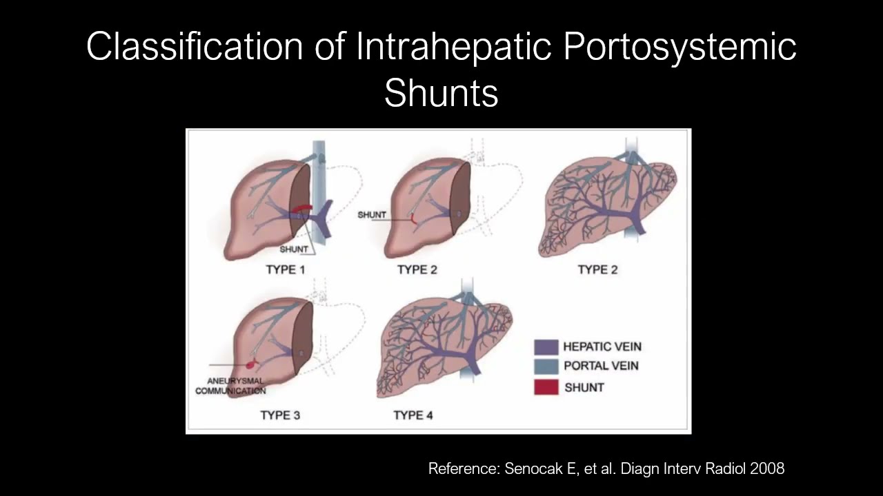 Intrahepatic aneurysmal portosystemic venous shunt diagnosed on EUS ...