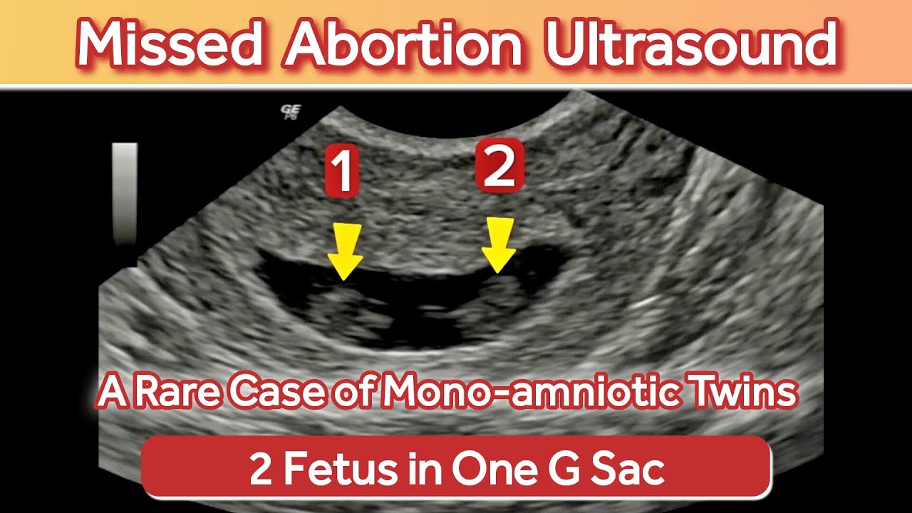 Twin Missed Abortion Ultrasound | 2 Fetus in 1 G Sac , Mono-amniotic ...
