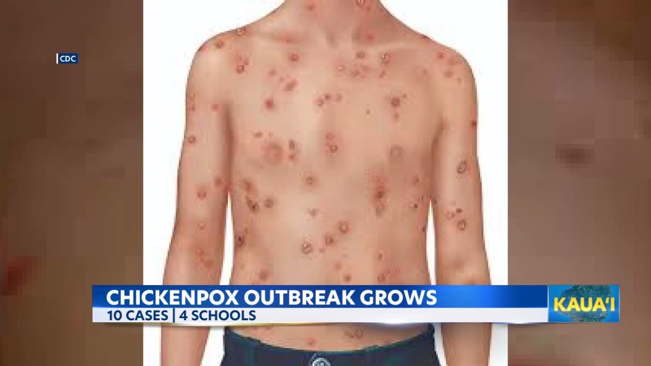 Kauai chickenpox outbreak increases to 10 cases across 4 schools - YouTube