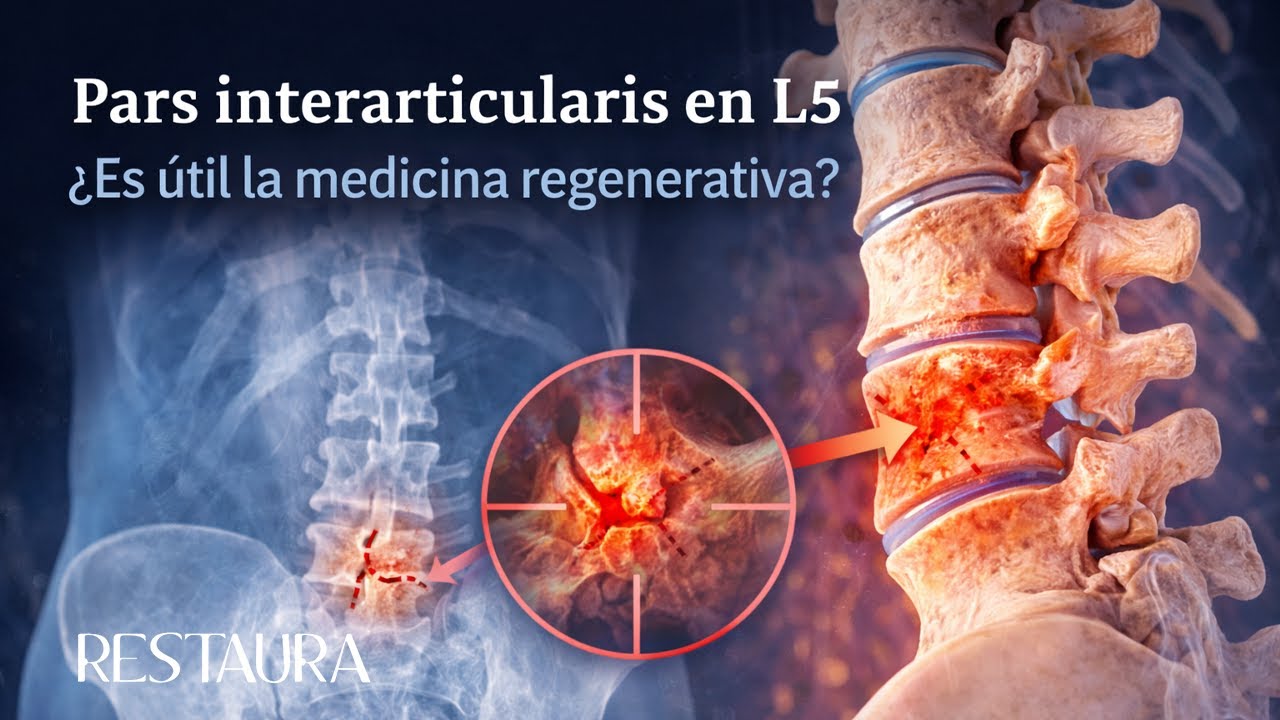 Pars interarticularis en L5: la lesión por sobreuso que muchos ignoran ...