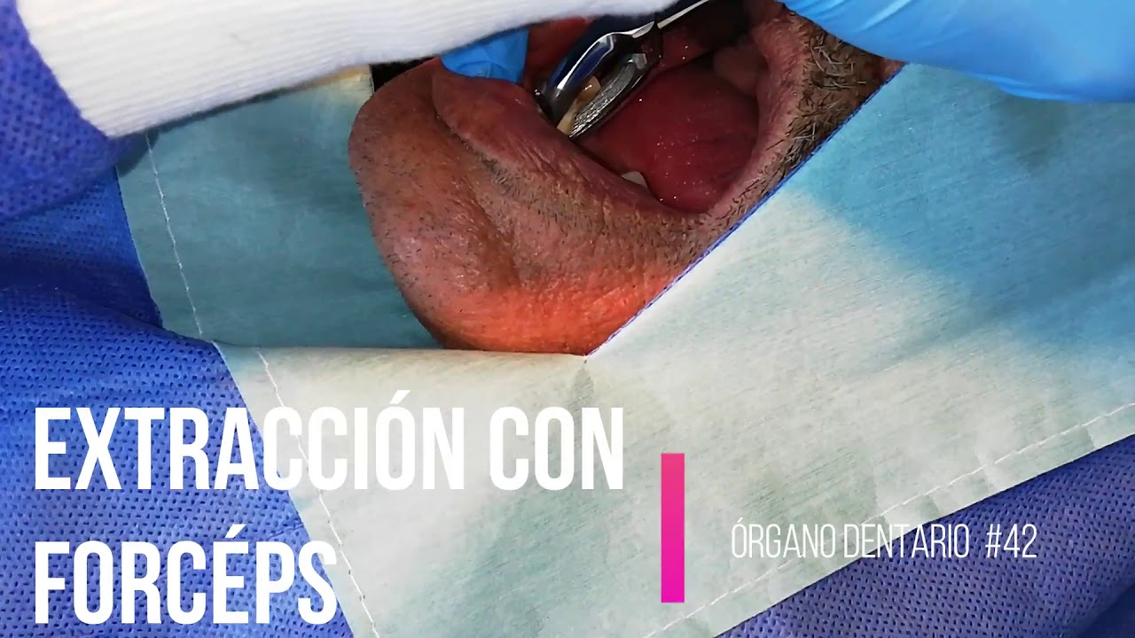 Extraccion simple de Órgano Dentario #42,43 y #44 - YouTube