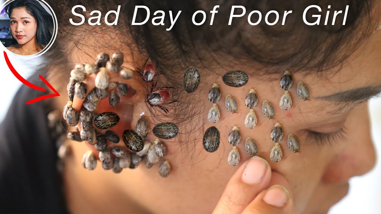 Remove Giant Ticks is Living on Poor Girl's Ear Remove ? #301 - YouTube