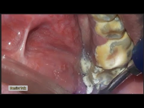 Huge calculus / tooth scalling /pembersihan karang gigi - YouTube
